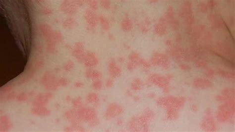 Maculopapular Rash Definition Signs And Symptoms Types Causes