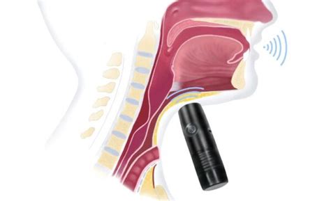 What Is An Electrolarynx