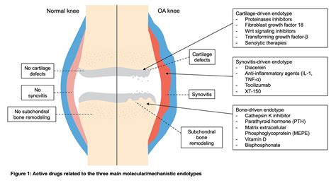 Active Synovitis