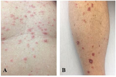 Figure 1 From Lymphomatoid Papulosis In A Case Of Atypical Secondary