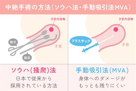中絶手術｜名古屋のエマ婦人科クリニック名古屋栄【mva法可】