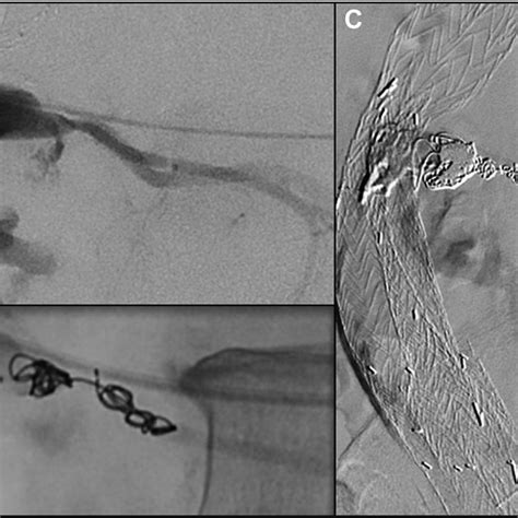 Intraoperative Angiographic Images A Selective Contrast Injection Download Scientific