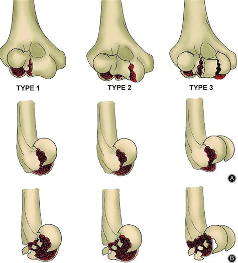 Dubberleys Classification Of Capitellar Andor Trochlear Fractures