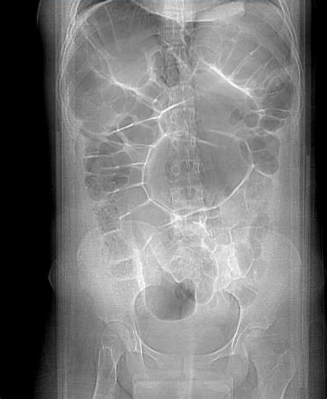 Scout Image From Initial Computerized Tomography Suggesting Sigmoid