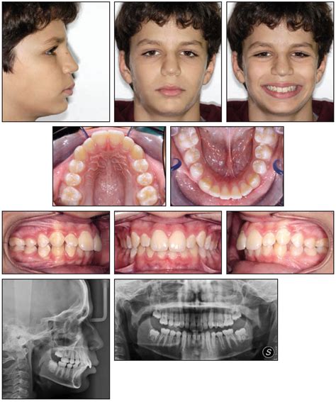 Timing Considerations For Mandibular Advancement With Aligners