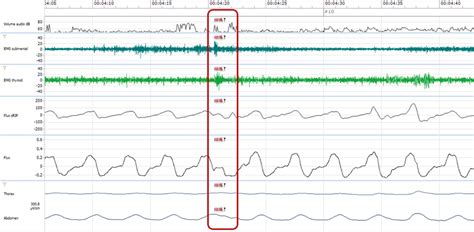 Capture Of A Swallowing Act In Patient Id3 At Time 1 00 04 20 Download Scientific Diagram