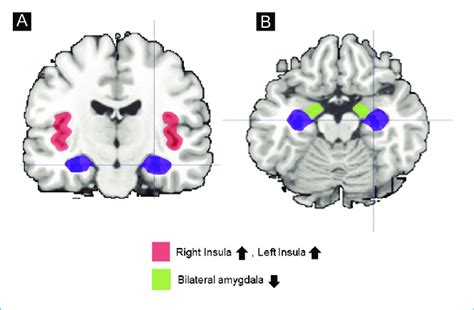 Brain Alterations Described In Autonomic Challenge Valsalva Fmri Download Scientific Diagram