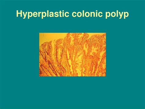 Ppt Colon Polyps Powerpoint Presentation Free Download Id 144545