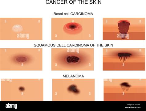 Vector Illustration Of Skin Cancer In The Initial Stage And At The