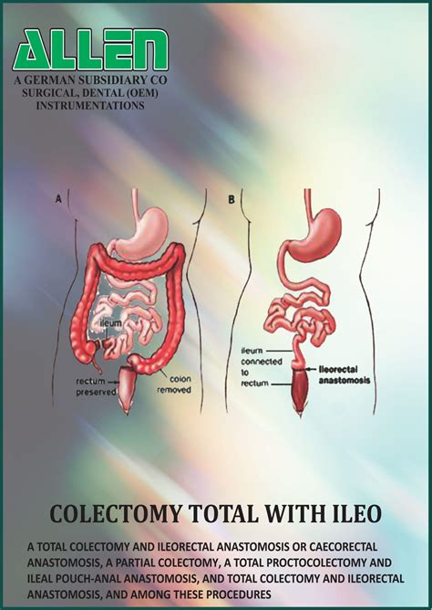 General Surgery Allen Surgical