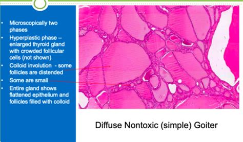 Block 6 Path Diffuse And Multinodular Goiter Flashcards Quizlet