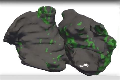 Personalized Simulations Lead To More Accurate Successful Treatment For Common Heart Rhythm