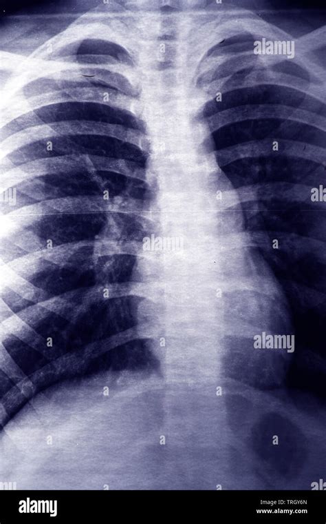 Chest X Ray Pneumonia Hi Res Stock Photography And Images Alamy