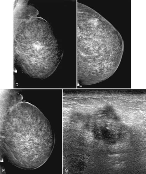 Mammogram Interpretation Radiology Key