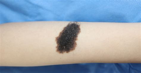 거대 선천성 멜라닌 세포 모반 흑색종 가능성성장하며 같이 커져