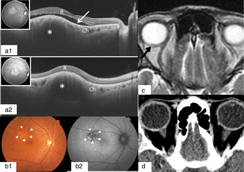 Oct Images At The First Visit Showed A Metastatic Lesion Of The Choroid