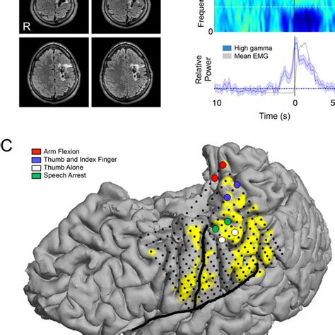 Spatiotemporal Patterns Of Cortical Activity Linked To Muscle Download Scientific Diagram