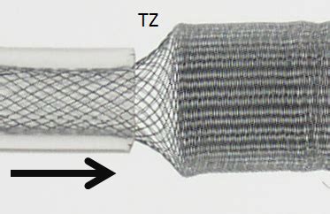 Pipeline Device Guide Neuroangio Org Pipeline Device Guide Neuroangio Org
