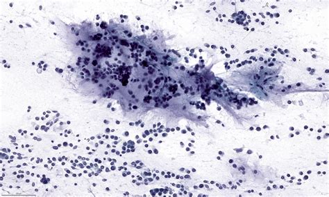 Pathology Outlines Pleomorphic Adenoma