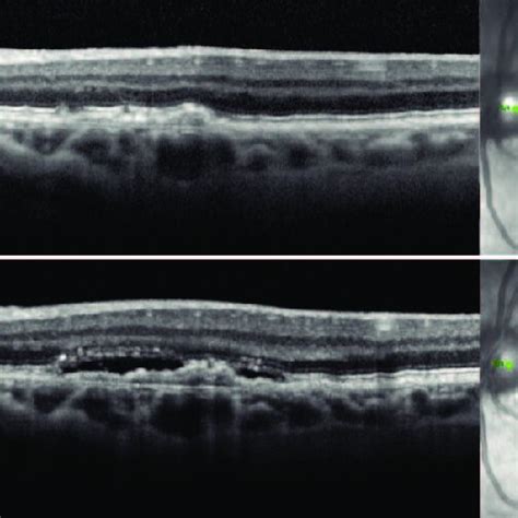 Protocol Of Image Analysis The Oct Fundus Image A Was Used To Assist