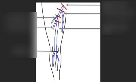 Id Dvt Pocus Diagram Quizlet