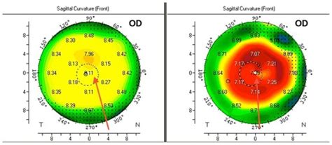 Full Article Topography Guided Hyperopic And Hyperopic Astigmatism