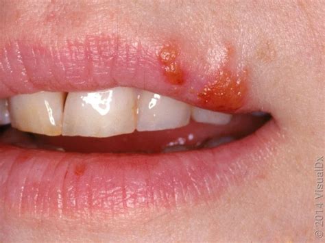 What Does A Cold Sore Look Like Heres How To Diagnose One Goodrx