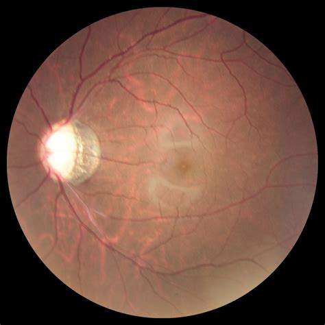 Pamixsun Swinv Tiny For Glaucoma Classification At Main