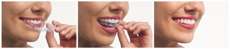ITero For Invisalign Santa Rosa CA Fountaingrove Dentistry