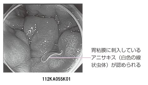 112A55 胃アニサキス症 国試 M3E Medical