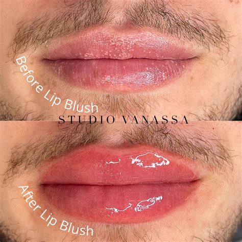 fordyce spots lips before and after