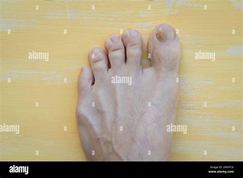 Toenails With Fungus Problemsonychomycosis Also Known As Tinea