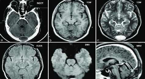 Computerized Tomography Of Head Plain Showing A Well Defined Midline Download Scientific