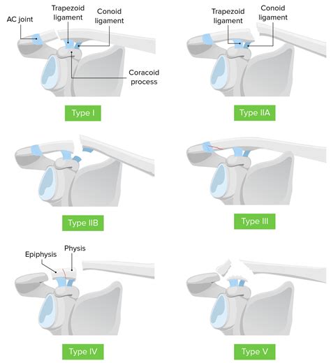 Clavicle Fracture Concise Medical Knowledge