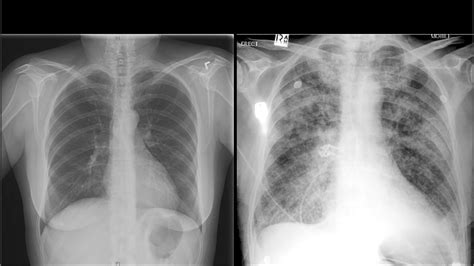 Image Classification Using Ai To Detect Pneumonia By Samuel Mohebban