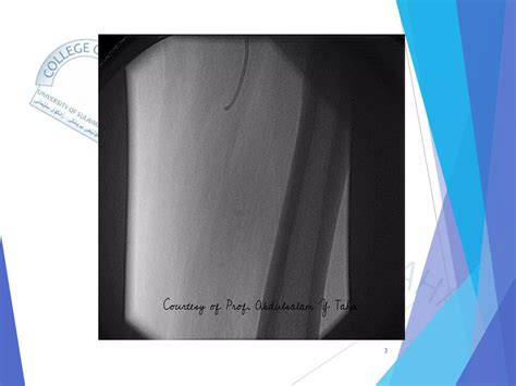 Superficial Femoral Artery Occlusionpdf