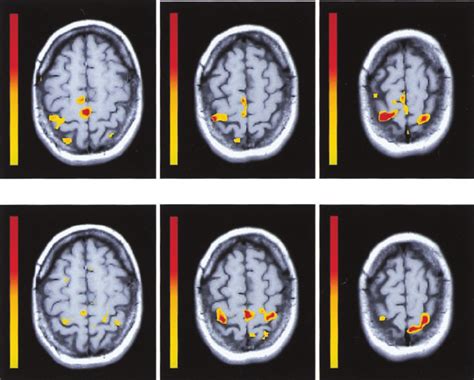 Cortical Activation Areas During Movements Of Existing Body Parts