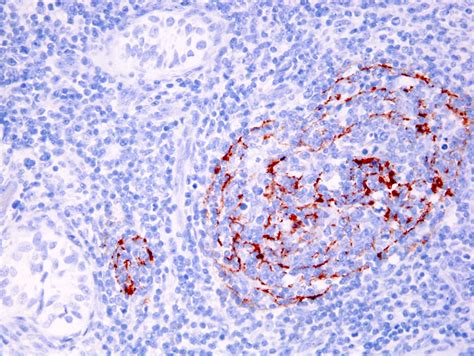 Pathology Outlines Primary Follicular Lymphoma Testis