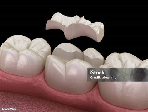 치아 위에 세라믹 크라운 고정을 상감 인간의 치아 치료의 의학적으로 정확한 3d 그림 상감 세공에 대한 스톡 사진 및 기타