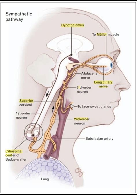 Best 13 Internal Carotid Artery And Its Aneurysms Artofit