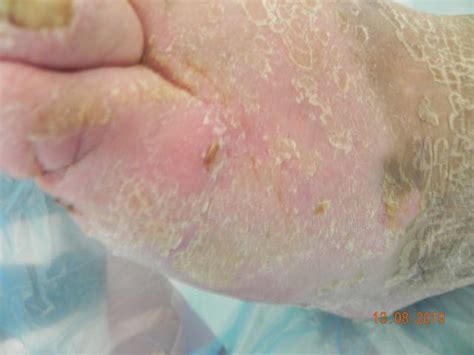 Dfu Object Detection Dataset And Pre Trained Model By Diabetic Foot Ulcer