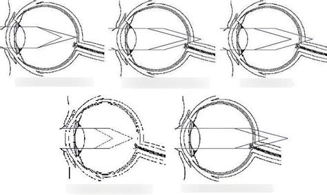 5 Classes Of Astigmatism Diagram Quizlet
