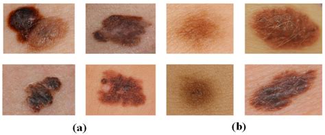 Different Skin Lesion Examples In The Isic 2018 13 Dataset Isic 2019 Download Scientific