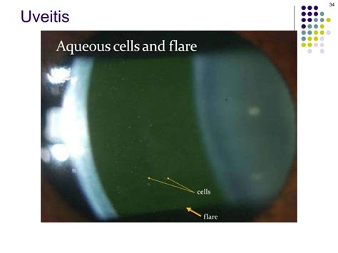 Uveitis In The Eye Anterior Uvitis And Posterior Uveitis Pdf Eye