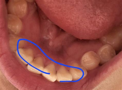 앞니 안쪽 이거 충치인가요 지식in
