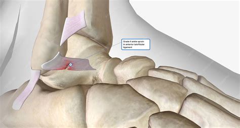 What Is A Full Thickness Tear Of The Anterior Talofibular Ligament At