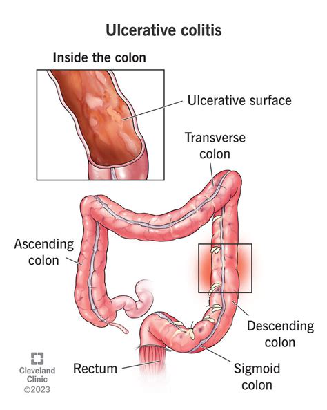 Ulcerative Colitis Overview Causes Symptoms And Risk Factors Apollo247
