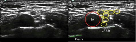 Ultrasoundguided Supraclavicular Brachial Plexus Block Brachial Plexus