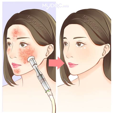 Best Acne Treatment Acne Scars Treatment In Johor Bahru Johor