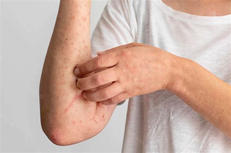 37 Facts About Smallpox